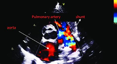 Echocardiogram Of Pda With Minimal Residual Shunt Across The Pda Device Download Scientific
