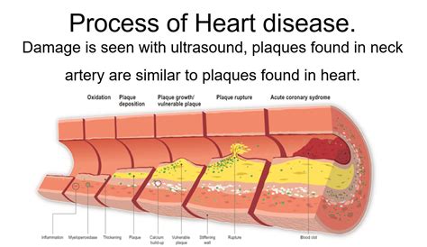 What Is Intima Media Layer Journey Of Health