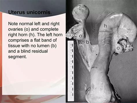 Pelvimetry Pelvic Abnormalitiescongenital Defects Of Female Reptract