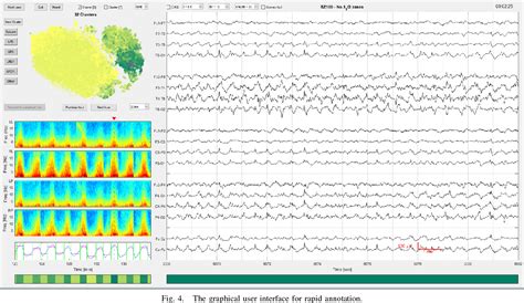 Figure 4 From Rapid Annotation Of Seizures And Interictal Ictal Continuum Eeg Patterns