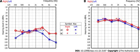 Sensorineural Hearing Loss Audiogram