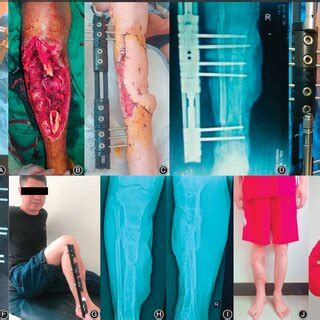 An Yearold Male Patient With Posttraumatic Tibial Defect Associated Download Scientific