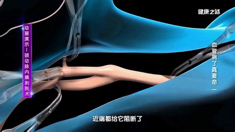 颈动脉有了斑块可以通过颈动脉内膜剥脱术或颈动脉支架植入术处理 手机新浪网