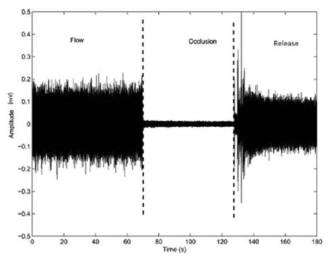 Representative Waveforms From Implanted Doppler Device With Wireless