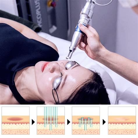 Premier Zero Pimple Premier Clinic