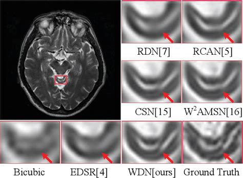 Figure 1 From Wavelet Dual Stream Network For Brain Mr Image Super Resolution Semantic Scholar