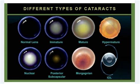 Cataract Definition