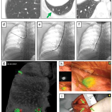 An Example Of The Procedure In A Patient With Three Multiple Pulmonary Download Scientific