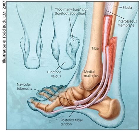Posterior Tibialis