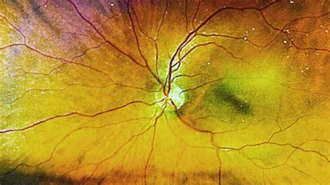 What Are The Different Stages Of Diabetic Retinopathy
