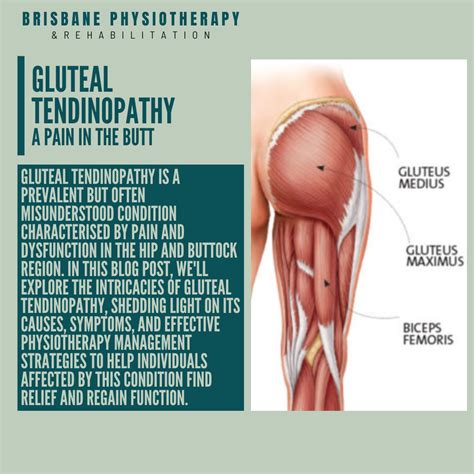 Gluteal Tendinopathy A Pain In The Butt Brisbane Physiotherapy