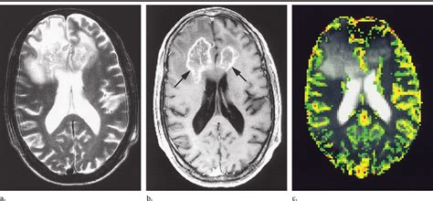 Toxoplasma Encephalitis In A 47 Year Old Man A Transverse Download Scientific Diagram