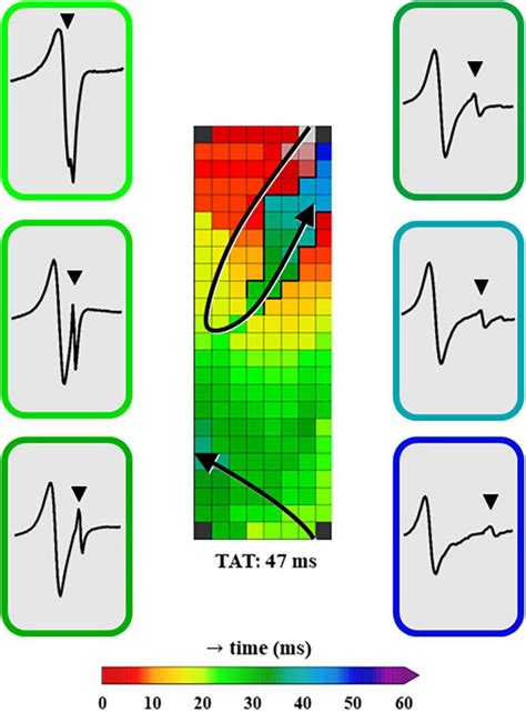 A Color Coded Activation Map Constructed Using Unipolar Egms In Which Download Scientific
