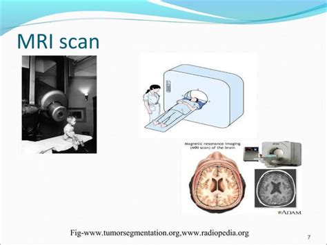 Brain Tumor Detection By Thresholding Approach Ppt Free Download