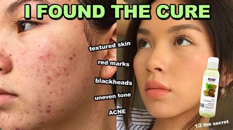 Acne Marks Redness At Andrew Leichhardt Blog