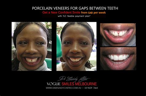 Close Gaps And Spaces Between Front Teeth Melbourne