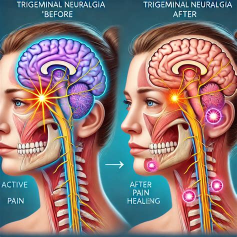 Trigeminal Neuralgia The Body Can
