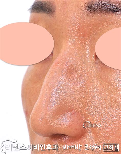 비개방 코재수술 무보형물 코성형 휜코 매부리코 코끝 수술 전후사진 S1253