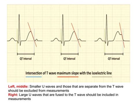 Qt Interval In Ecgcauses Of Short And Long Qt Interval Ppt