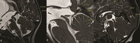 Sagittal T2 Weighted 3d Sampling Perfection With Application Download Scientific Diagram