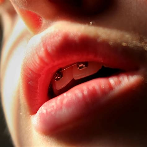 Brackets Metálicos Estéticos Mvoca