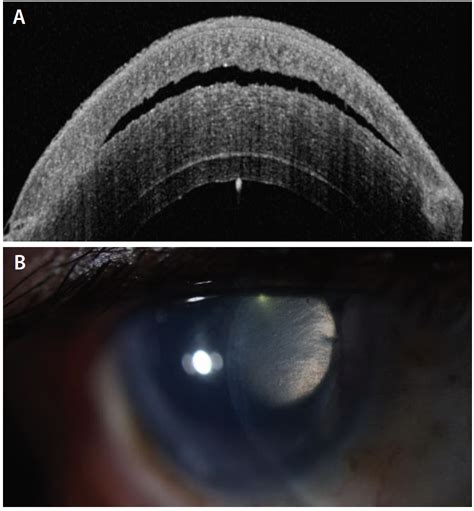 Crstoday Persistent Lasik Flap Interface Fluid After Dsaek Procedure