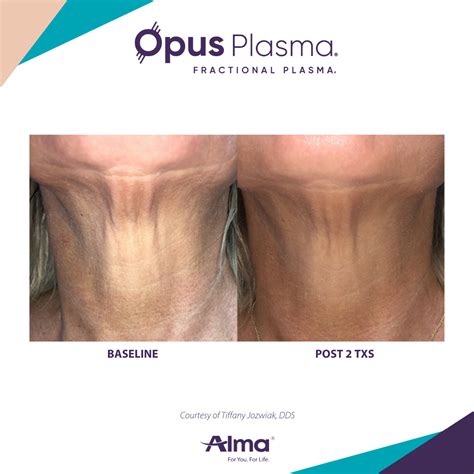Fractional Laser Resurfacing For Aging Skin Colair Med Spa