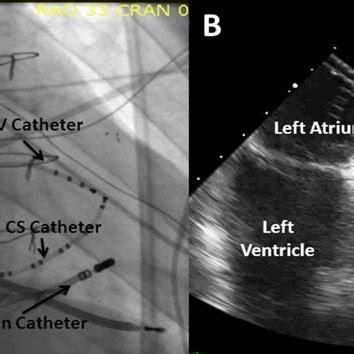 Patient With A Tandemheart Device In Place A Is A Right Anterior