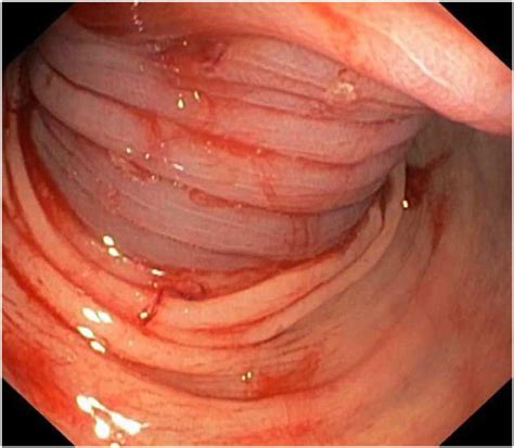 Colonoscopy Performed After Rectal Prolapse Reduction Identifying