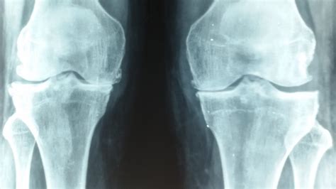 Tkr Primary Total Knee Replacement Dr Girish Dewnany