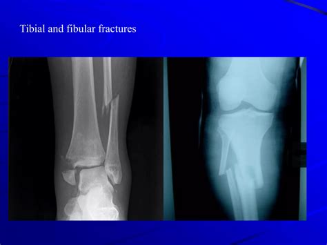 Fractures 0f Lower Limb Pptx