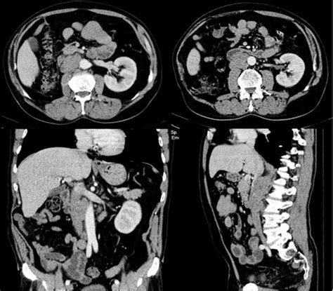 Preoperative Ct Scan See Text For Details Download Scientific Diagram