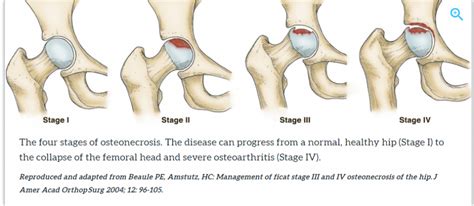 Avascular Necrosis Treatment Of Hip At Aior Avascular Necrosis Of The