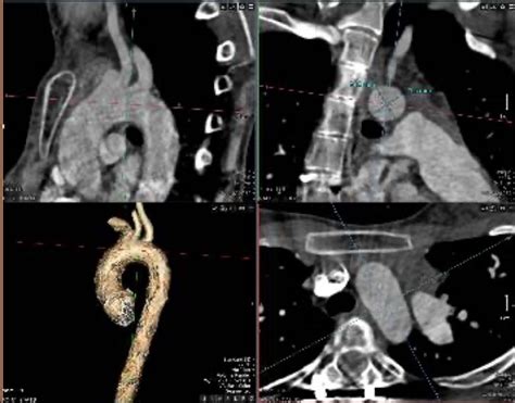 Posterior Nutcracker Syndrome Rradiology