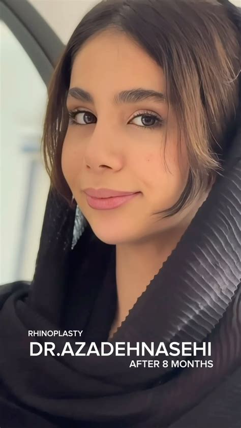 ‎جراحی بینی دکتر آزاده ناصحی‎ Drazadehnasehi • Instagram Photos