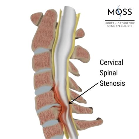 Cervical Stenosis With Myelopathy Modern Orthopedic Spine Specialists