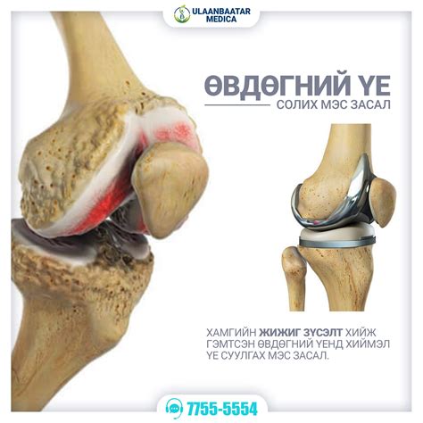 Өвдөгний үе солих Үеийг Ulaanbaatar Medica Clinic