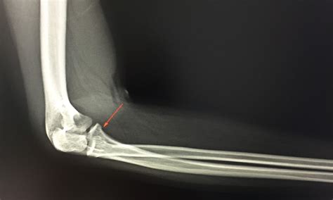 Radial Head Fracture Core Em Olecranon Fracture Broken Elbow Bone