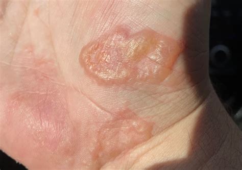 Rashblister On My Hand Any Thoughts Rdermatology
