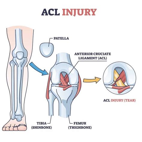 Acl Injuries Is Surgery The Only Option