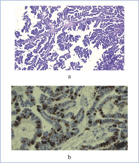 Histopathology Of A Choroid Plexus Tumor A Choroid Download Scientific Diagram