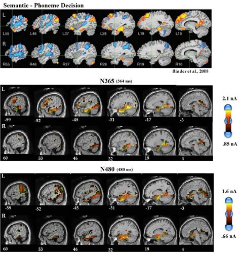 Figure 2 From Language Mapping With Dense Array Eeg Source Localization