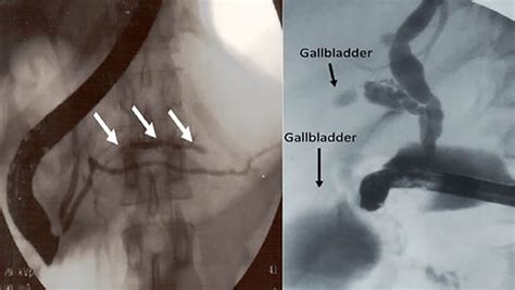 A Pancreas Bifidum Double Main Pancreatic Duct Arrow B Double