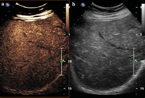 Hepatic Nodular Steatosis Ceus Image A Shows Homogenous Enhacement Download Scientific