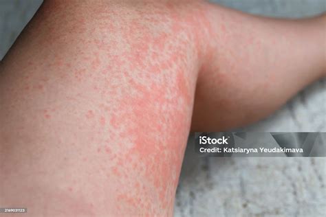 Allergic Rash On The Leg Photodermatitis Allergy To The Sun Ultraviolet