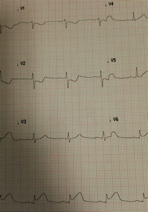 Beautiful Stemi We Just Had Stemi Was