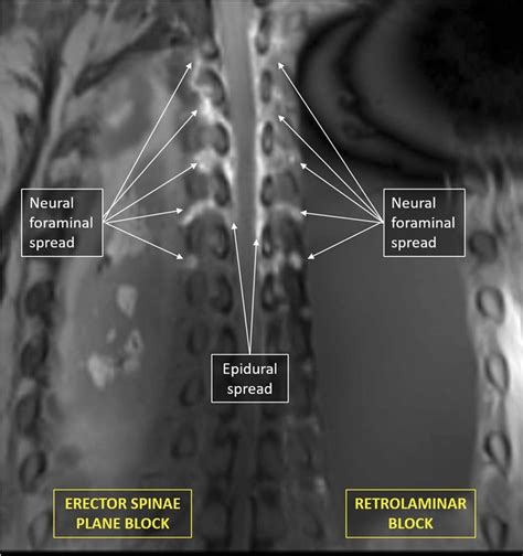 Erector Spinae Plane Block Versus Retrolaminar Blocka Magnetic Resonance Imaging And Anatomical