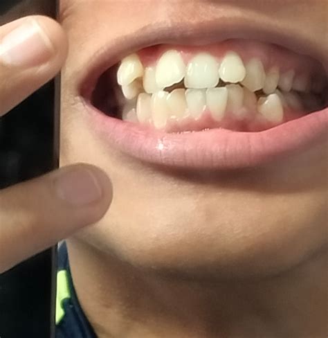 Do I Need Braces R Braces