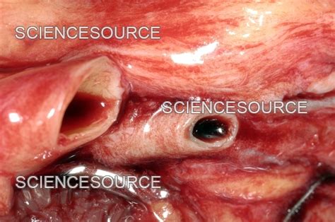 Arteries Post Mortem Gross Specimen Stock Image Science Source Images