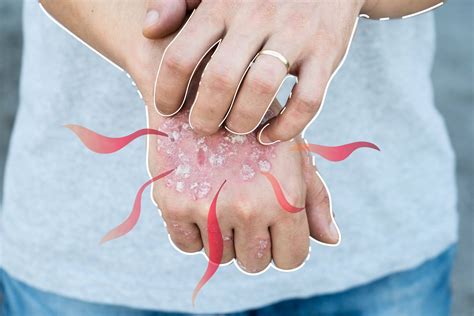 Мокнущая Экзема Диета — Похудение Диета Правильное Питание